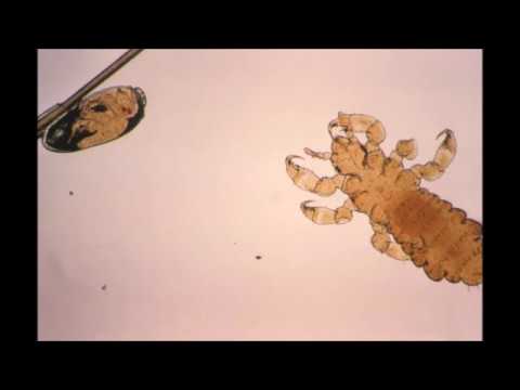 Pediculosis: Head and body lice - YouTube