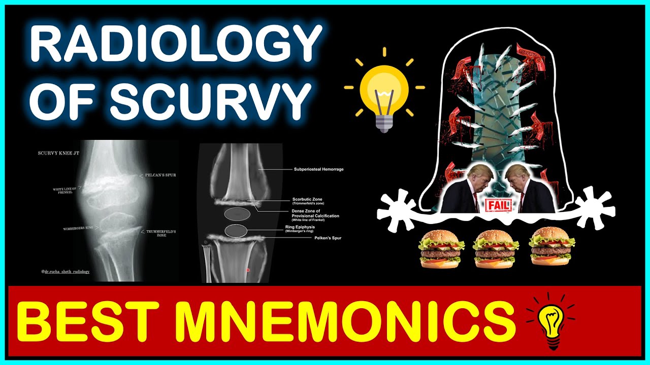 Radiological Findings of Scurvy | Pediatrics | Simplified MNEMONICS ...