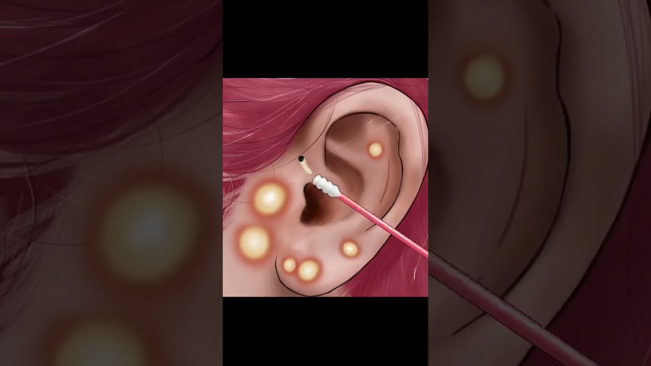 ystic Acne Extraction This Week, Blackheads Removal, Blackhead ...