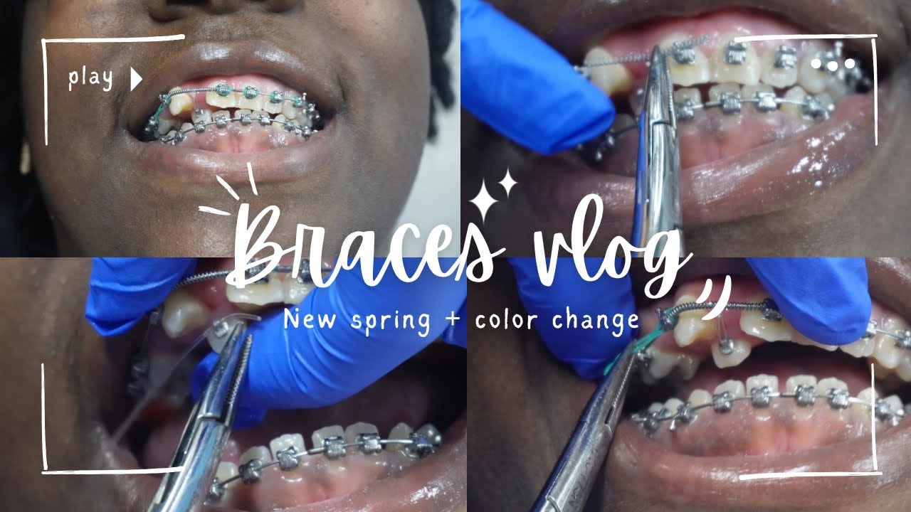 Life With Braces Ep:10 | Come with me to my braces appointment ! Color ...