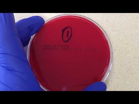 How To Read Strep Throat Test Results
