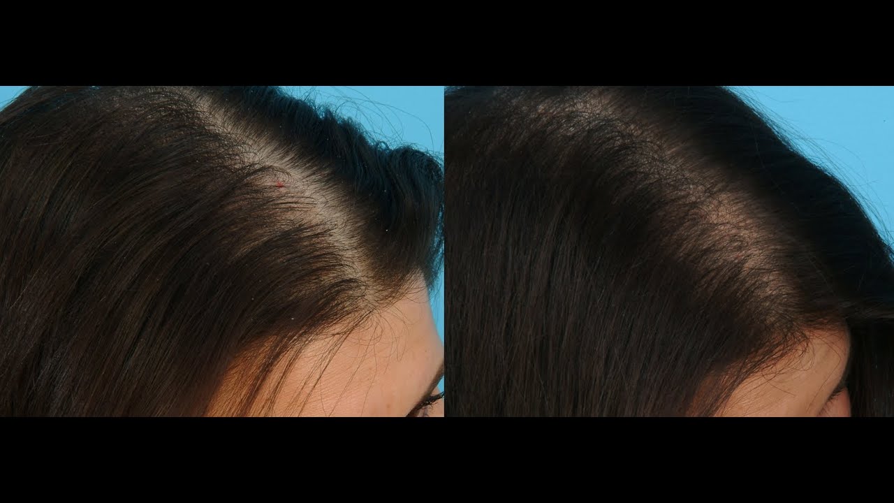 La Solución a mi Caída de Cabello - YouTube