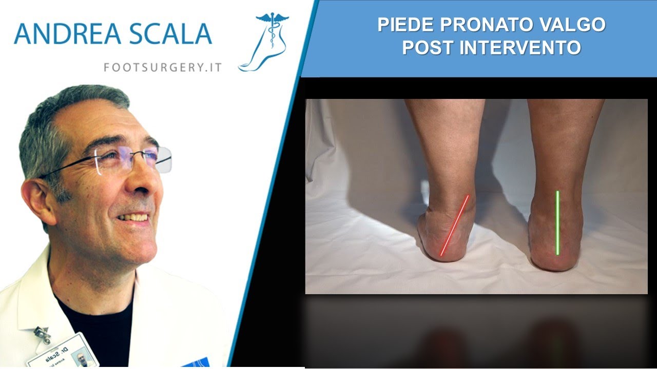 Piede Pronato adulto | Piede pronato valgo post intervento | Dott ...
