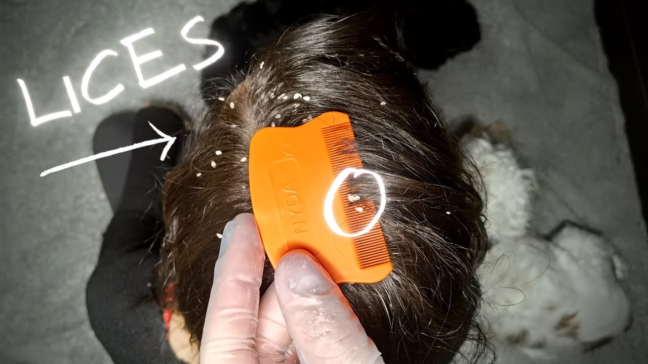 ASMR Lice removal, NO-Talking! Real person ASMR, Scalp Check / Lice Check. 💆 - YouTube