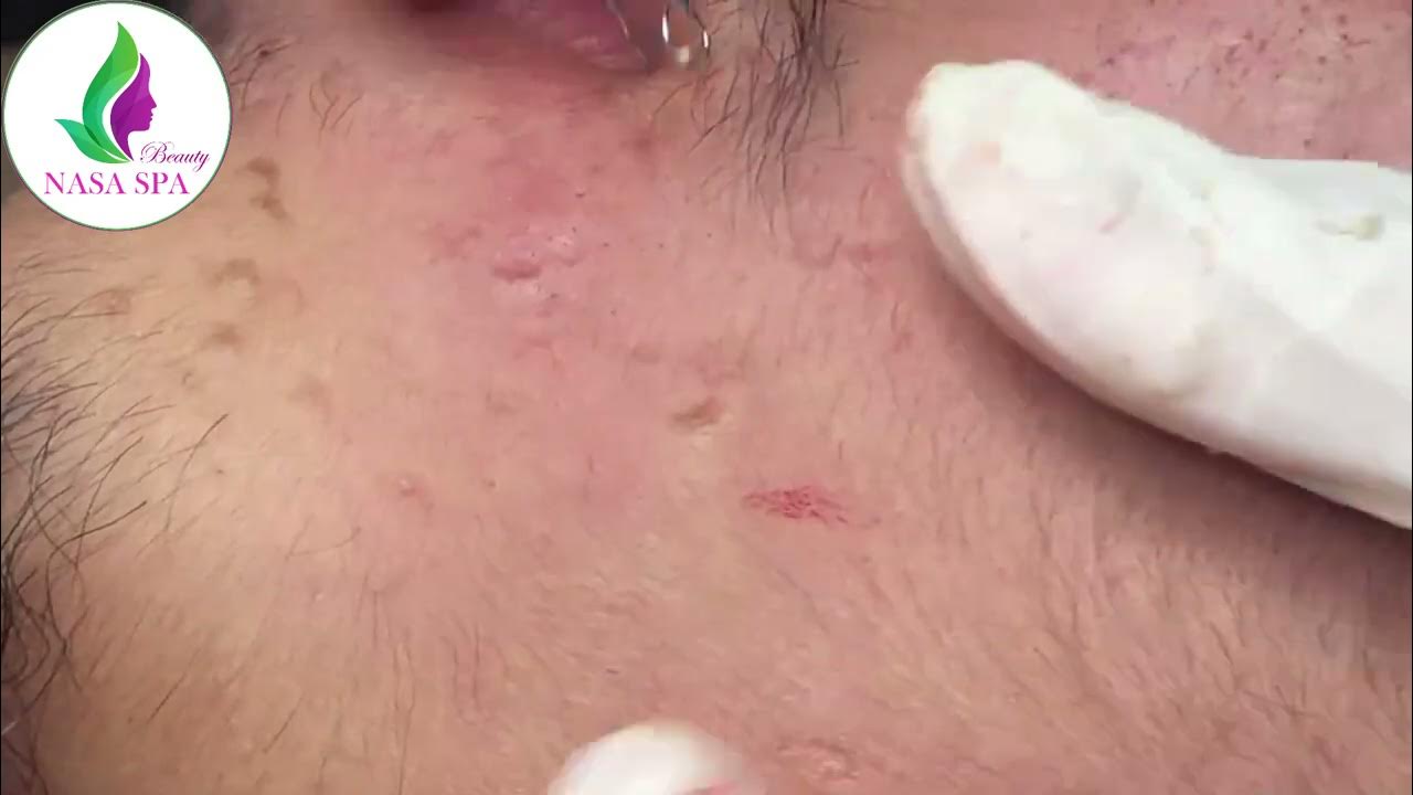 Satisfying Acne Blackhead Relaxing With Nasa Spa Beauty 001 Youtube