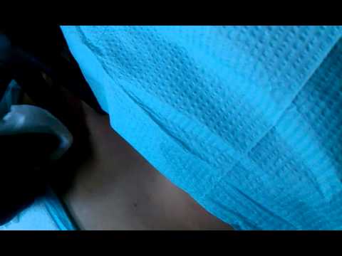 Back Dimple Thermal Piercings fast and easy at mission tattoos - YouTube