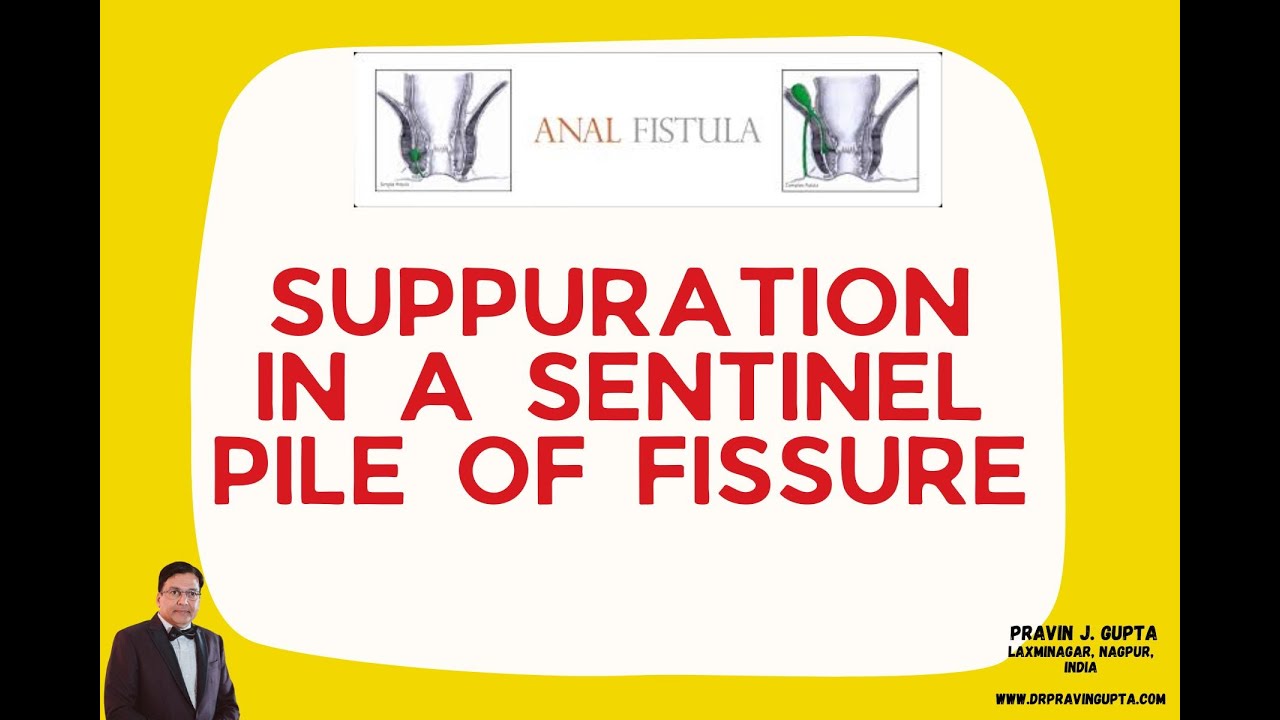 SUPPURATION IN A SENTINEL PILE OF FISSURE - YouTube