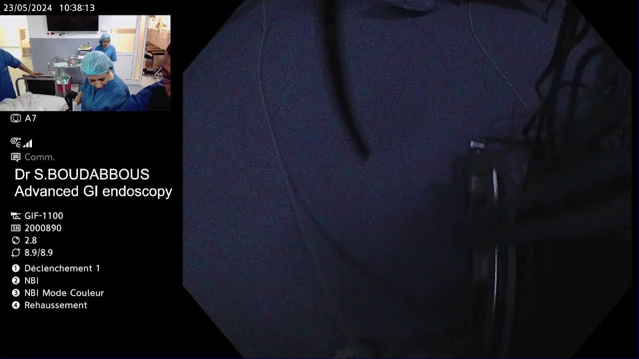 Diagnostic endoscopy for HB drop and black stool - YouTube