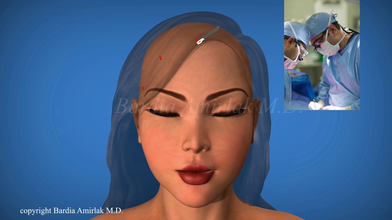 Migraine Surgery (Nerve decompression ) for Migraines, NDPH and ...