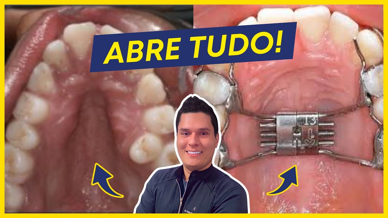 APARELHO ORTODÔNTICO PARA ABRIR O CÉU DA BOCA: COMO FUNCIONA? QUANDO ...