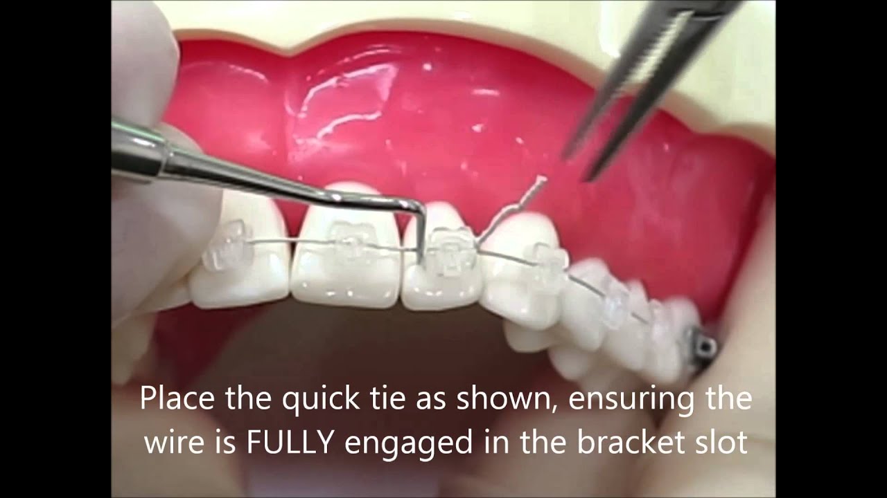 Quick Ties Placement - YouTube