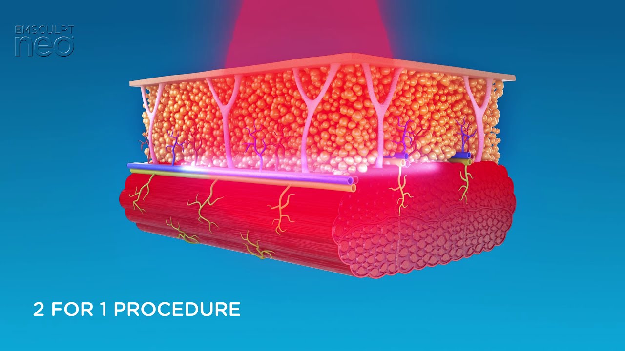 Emsculpt Neo: The One in Body Shaping - YouTube