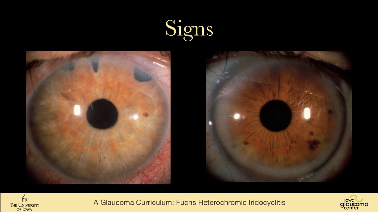 Iridocyclitis