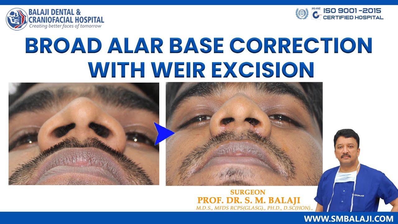 Broad Alar Base Correction with Weir Excision - YouTube