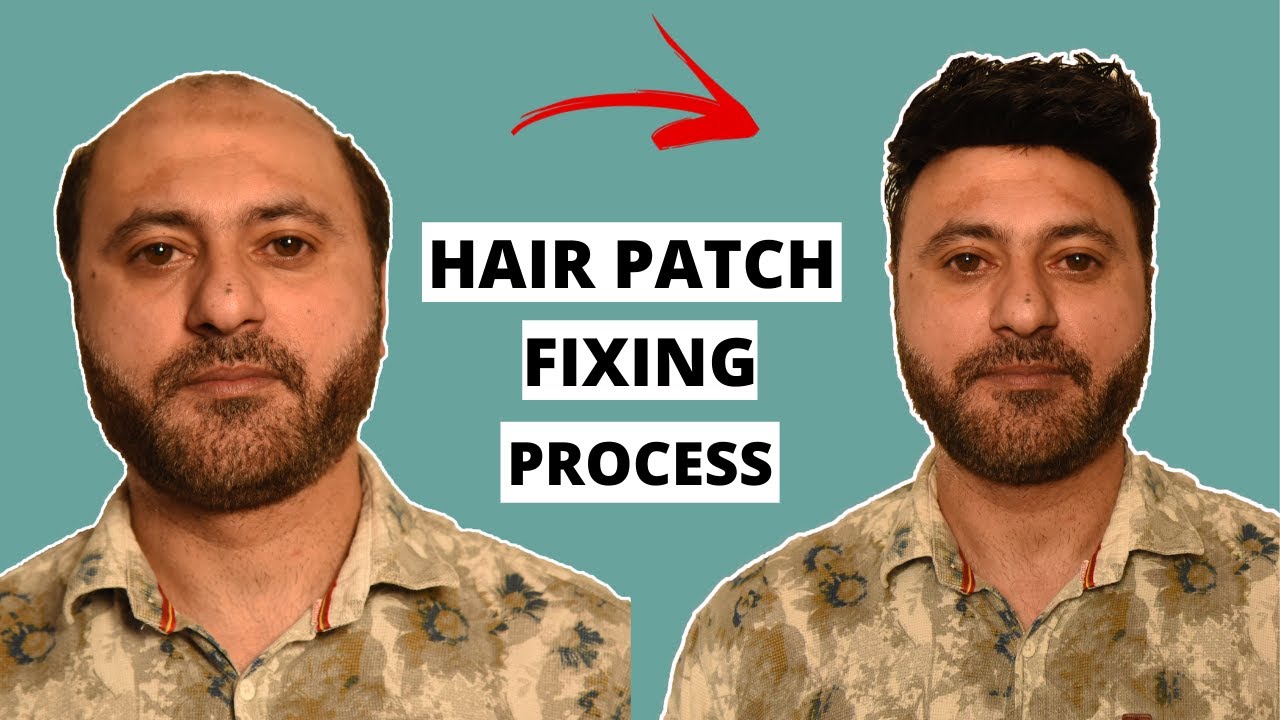 Hair patches for men in Delhi| Full step-by-step process🔥 - YouTube