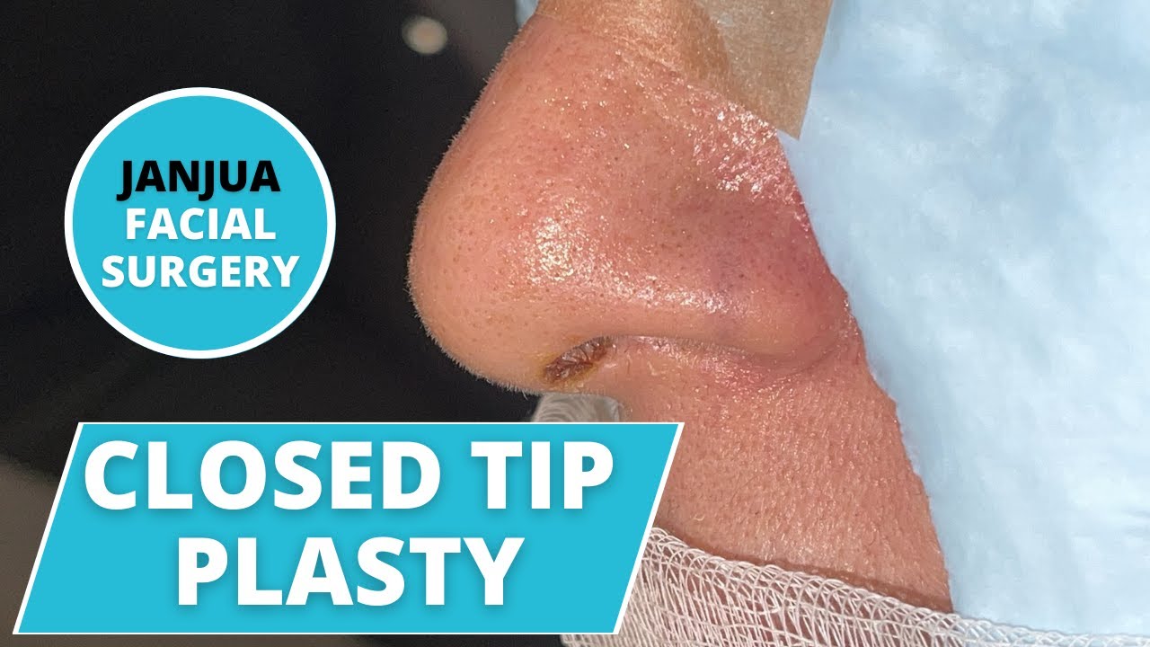 CLOSED TIP PLASTY - DR. TANVEER JANJUA - NEW JERSEY - YouTube