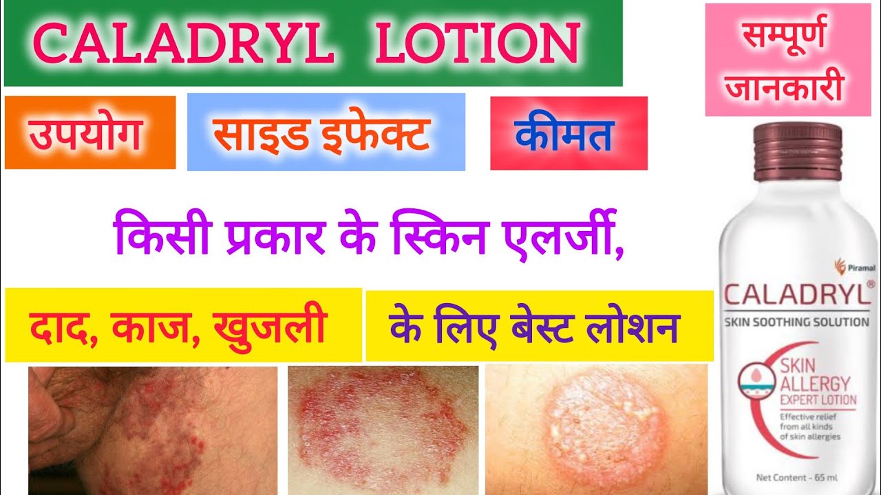 Caladryl lotion ke fayde / Caladryl skin soothing solution how to use ...