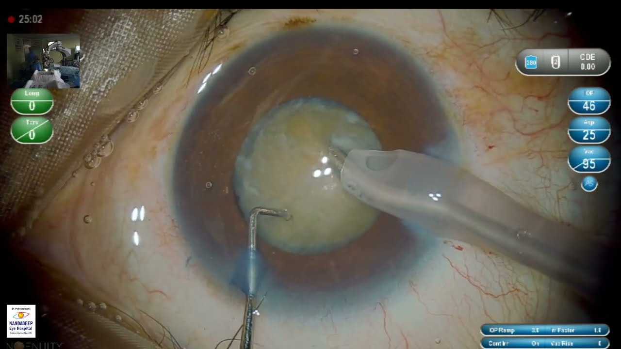Hyper mature cataract shallow ac Dr Sourabh D Patwardhan 3D live Phaco ...