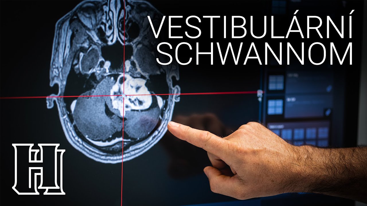 Vestibulární schwannom - neurinom akustiku - nádor sluchového nervu ...