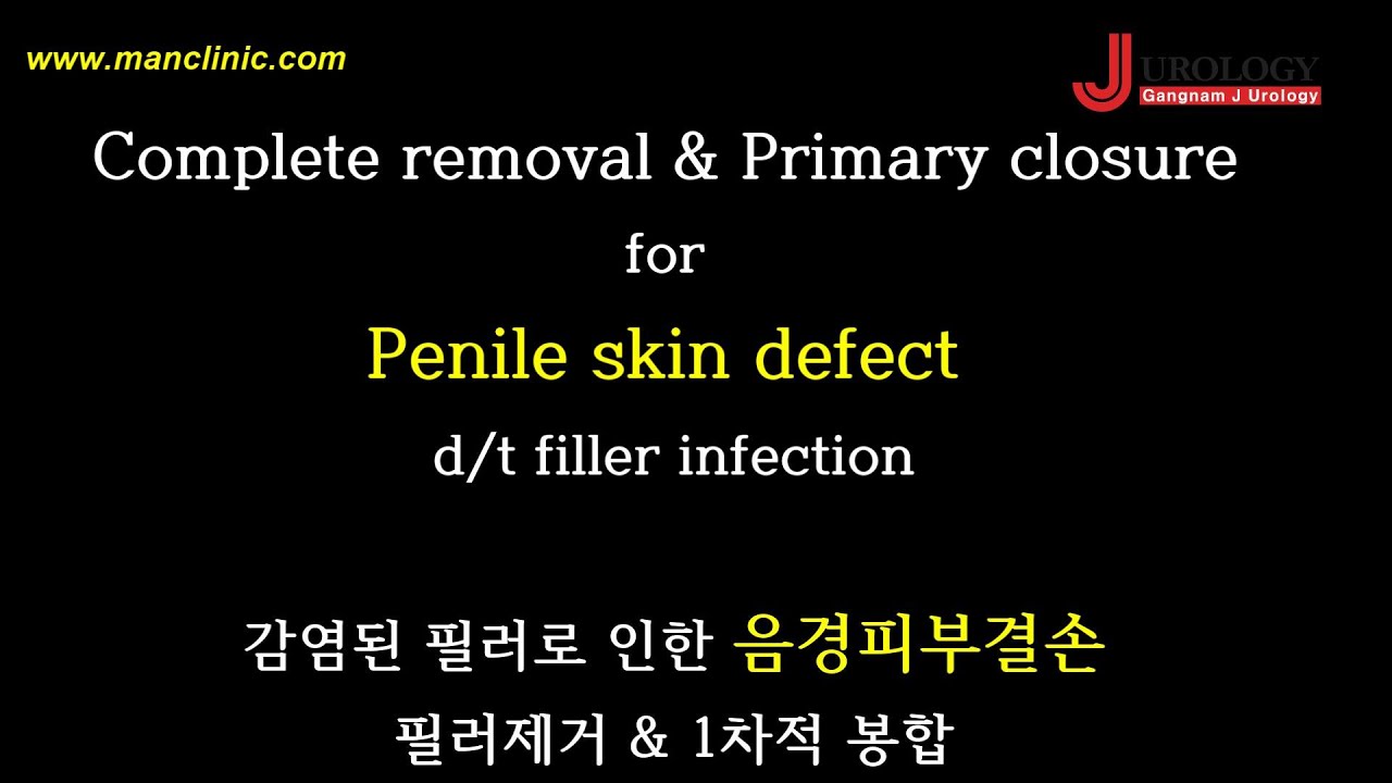 Removal & Primary closure for skin defect d/t filler infection - 필러로 인한 ...