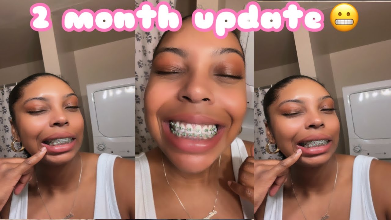 Braces update (2 months) - YouTube
