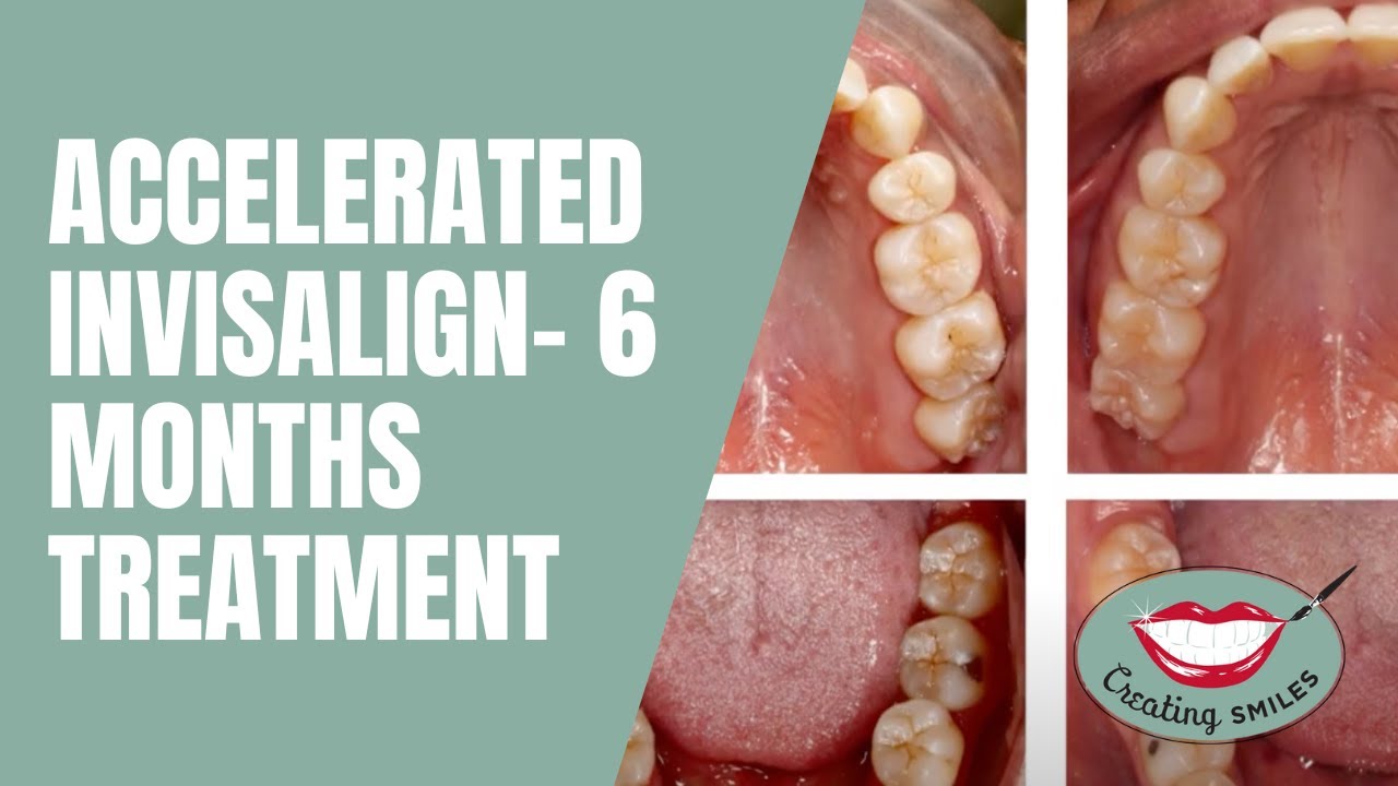Accelerated Invisalign- 6 months Treatment | Invisalign for Teens and ...