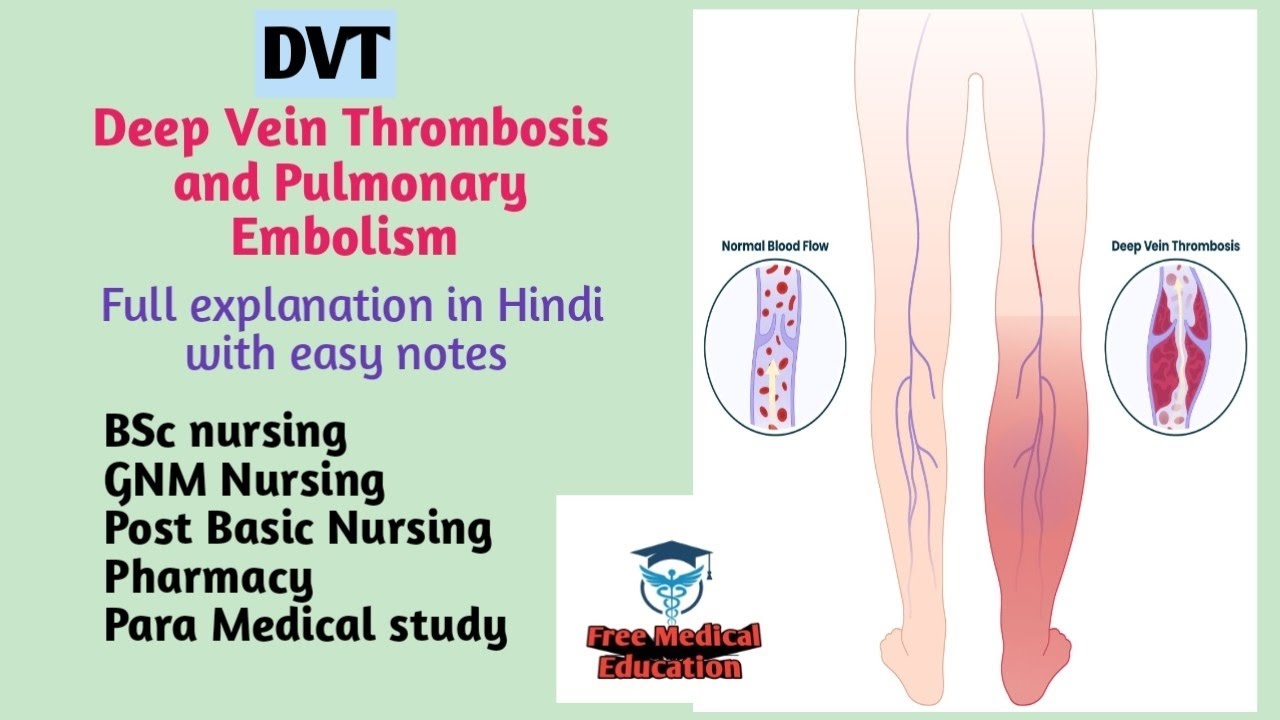 DVT (Deep Vein Thrombosis and Pulmonary Embolism )full explanation in ...