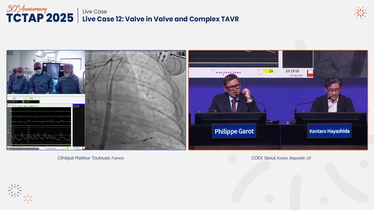 [TCTAP 2025] Live Case 12: Valve in Valve and Complex TAVR - YouTube