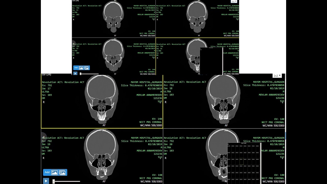 Endoscopic Nasal Valve Reconstruction for Empty Nose Syndrome - Dr ...
