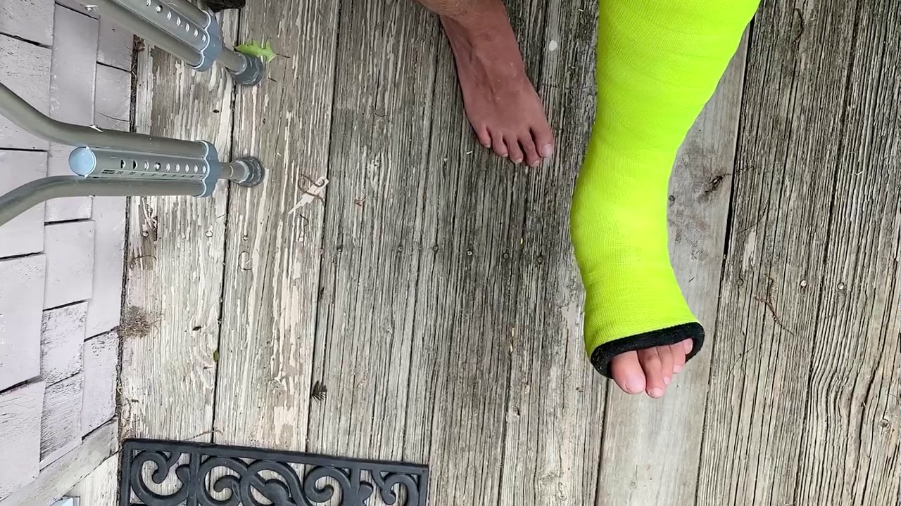 Broken leg cast - YouTube
