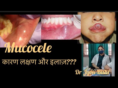 Mucocele||causes|symptoms|treatment|म्यूकोसिल।कारण।लक्षण|इलाज़ ...