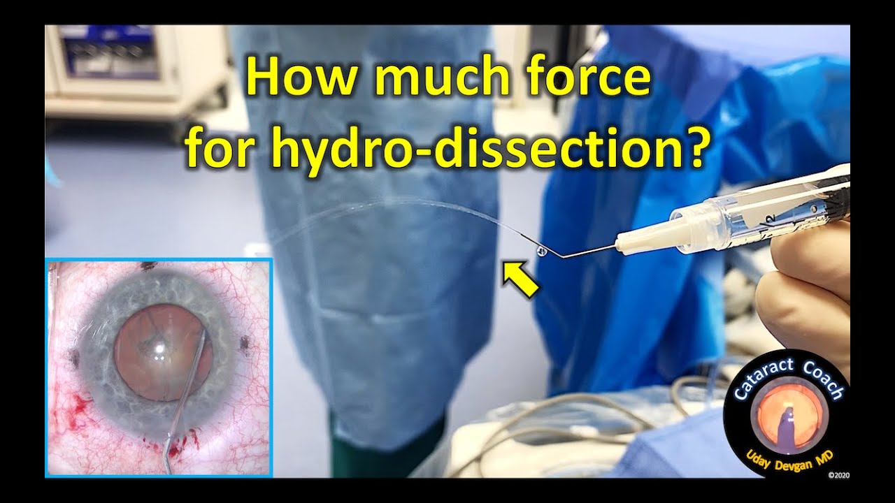 How much force for hydro-dissection in Cataract Surgery? - YouTube