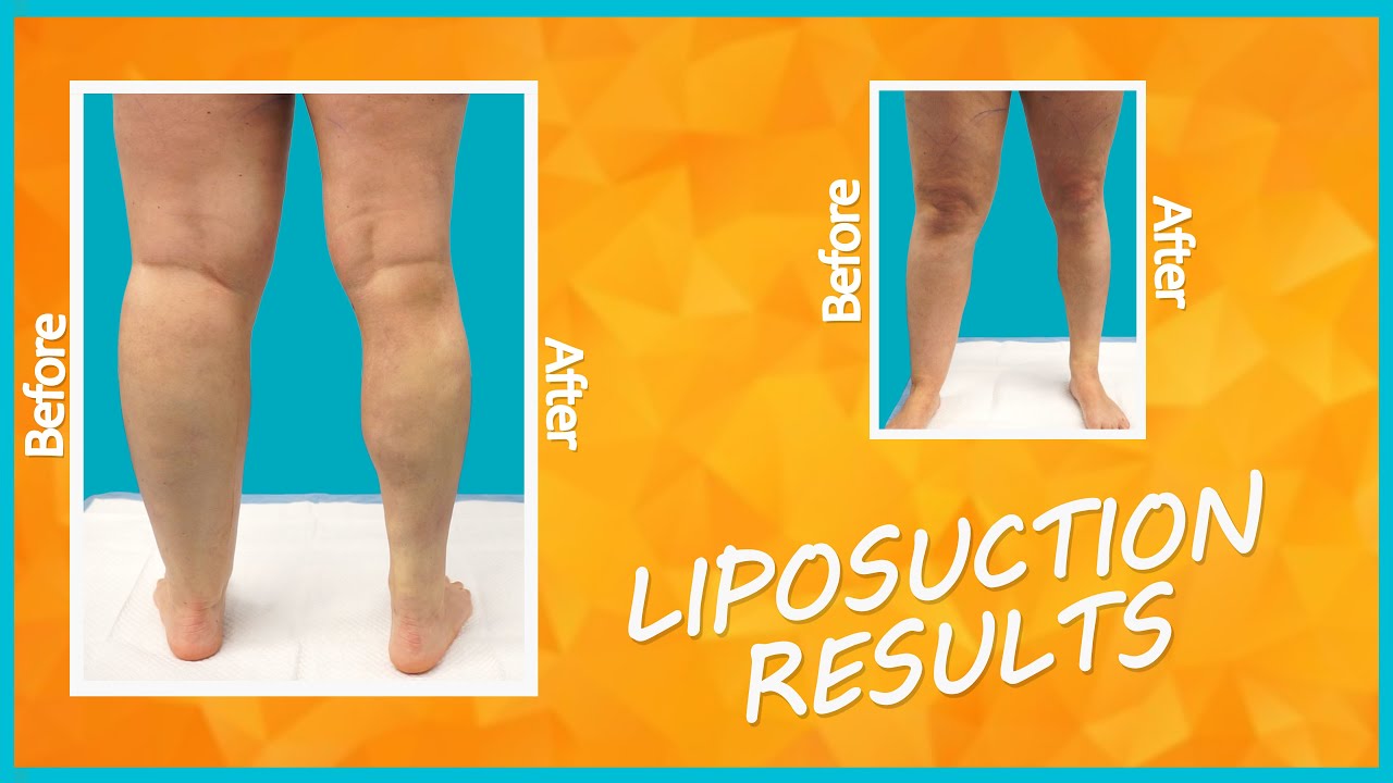 Lipo 360° | Liposuction Results | High-Definition | Expert Dr. Thomas ...