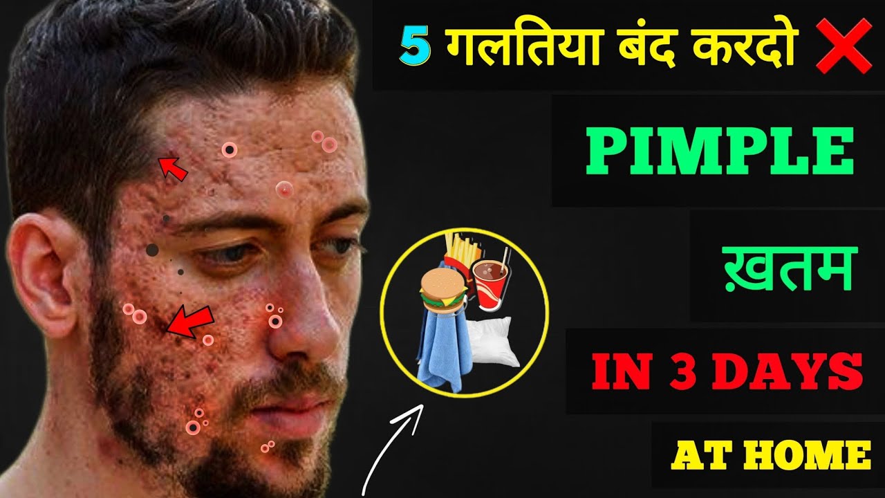 Top 5 Biggest Pimple Mistakes | How To Remove Pimple Fast For Boys in ...