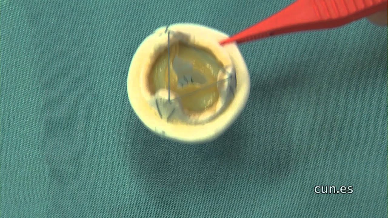 Válvula cardíaca mecánica o biológica para las enfermedades valvulares ...