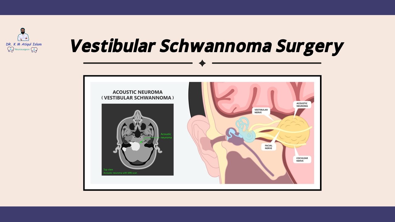 🔬 Vestibular Schwannoma Surgery: Step-by-Step Procedure & Recovery ...