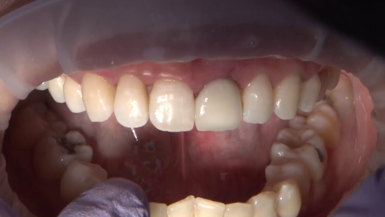 Chairside Live Episode 207: BioTemps® Provisionals in the Anterior ...