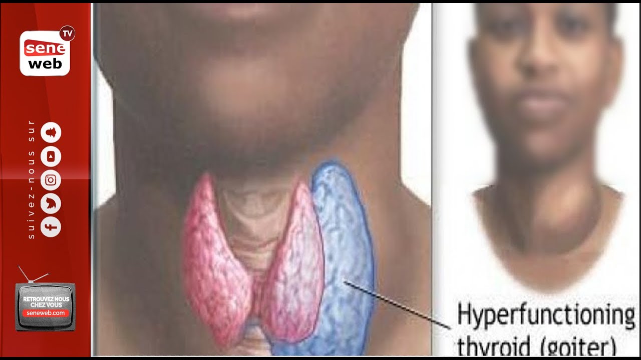 Actu Santé : Goitre - Causes, Conséquences, Traitements - YouTube