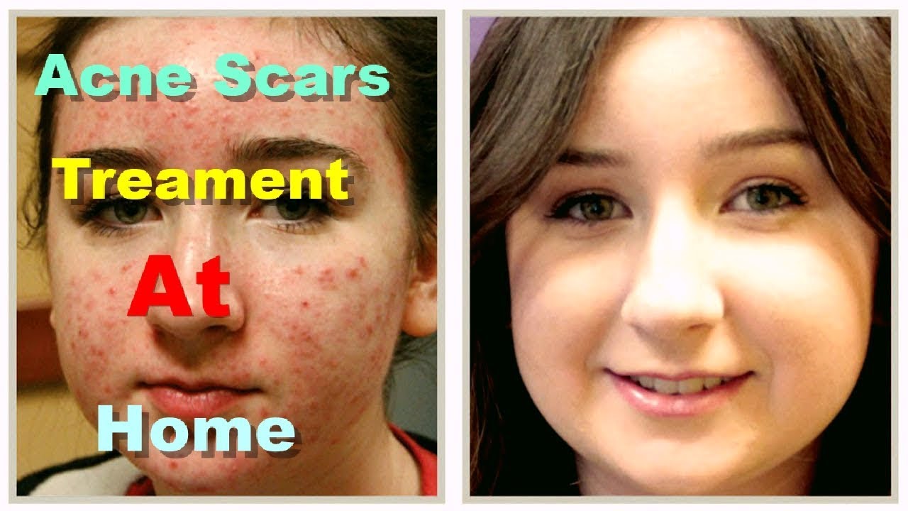 How To Acne Scars Treatment At Homeacne Scars Treatment Natural How Acne Scars Treatment Laser