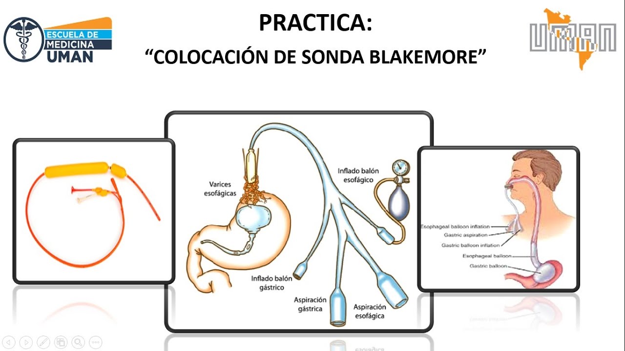 SIMULACION CLINICA - 2 SEMESTRE - COLOCACION DE SONDA SANGSTAKEN ...