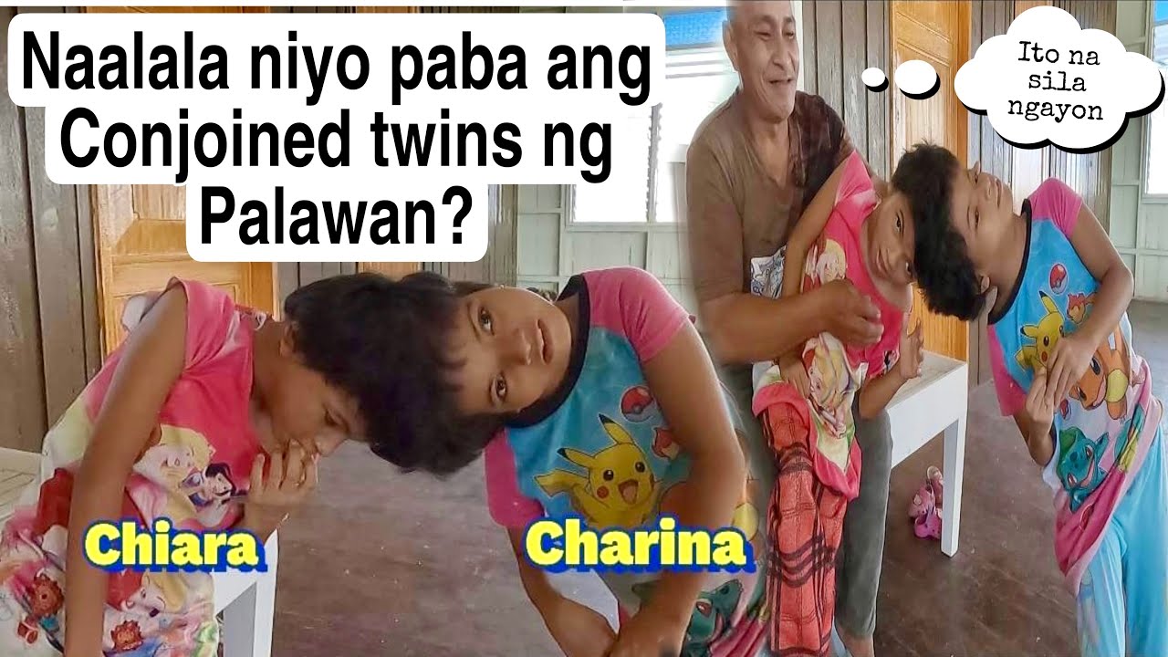 Ano ang kalagayan ng Nortega conjoined twins after Typhoon Odette ...