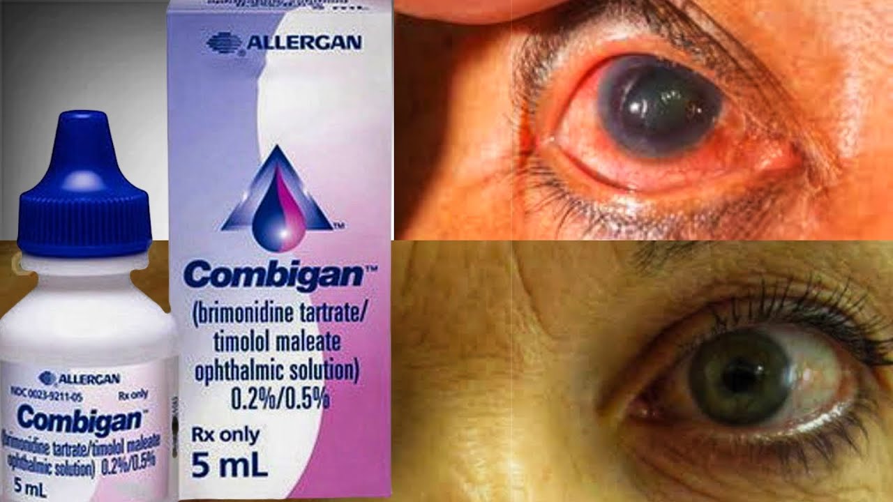 Combigan Eye Drop For Ocular Hypertension, glaucoma || Brimonidine ...