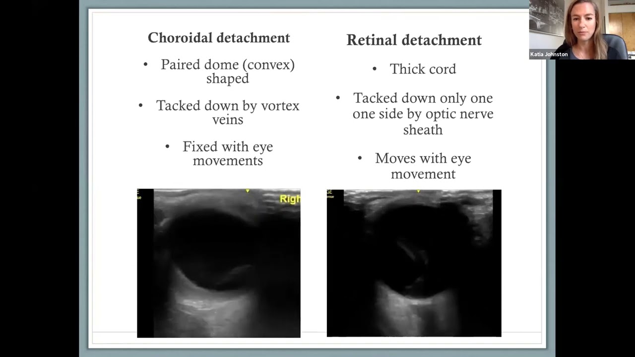 Vitreous Detachment Ultrasound