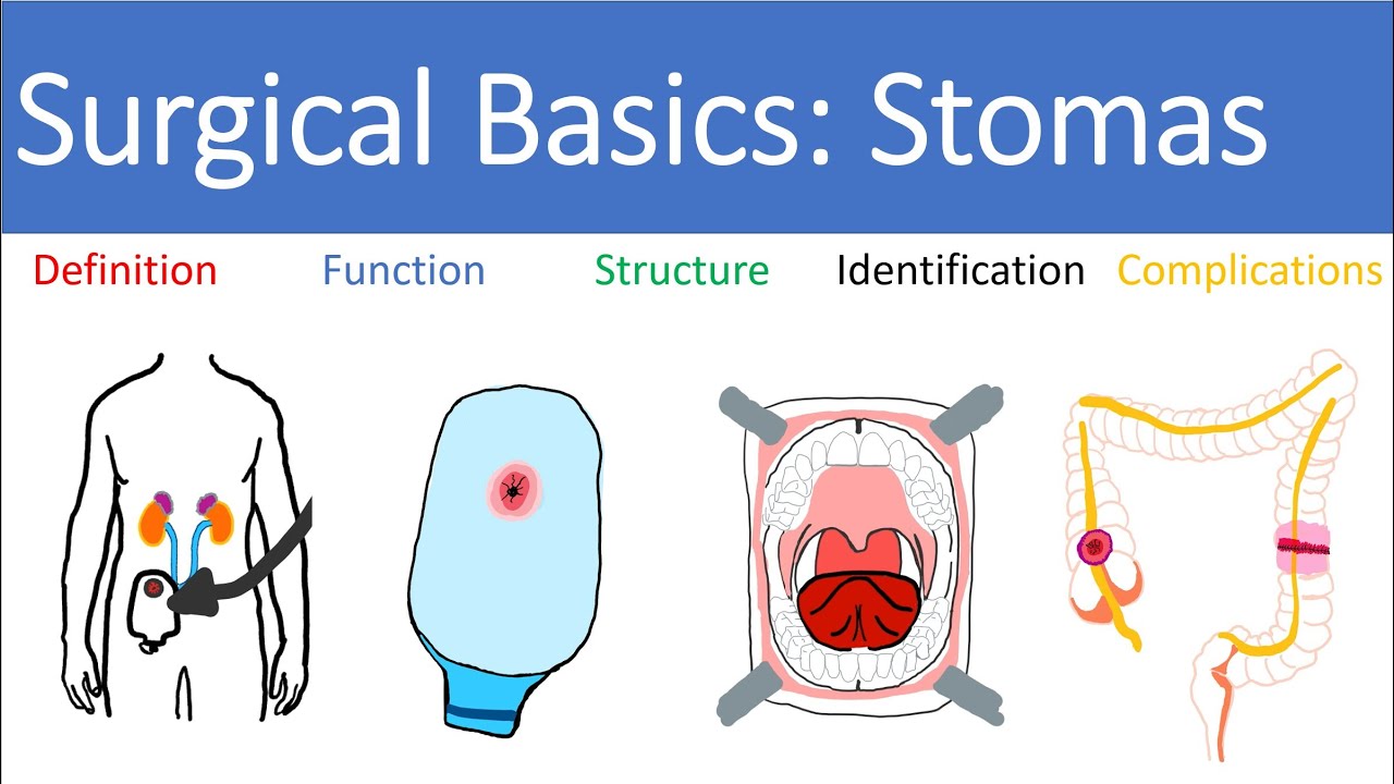 High Yield Surgery: Stomas - YouTube