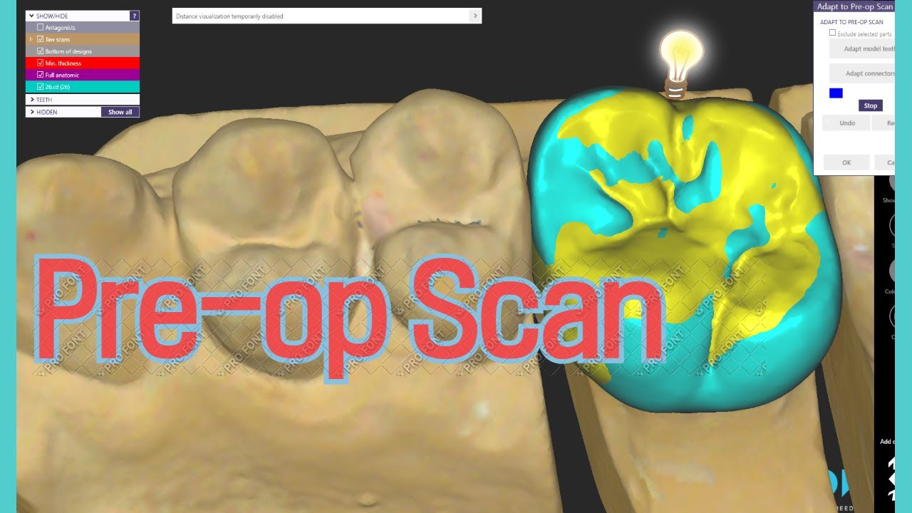 How to use pre-op scan / 치과기공사 엑소캐드 진단모델 저장 및 사용방법(라이브러리 만들기) - YouTube