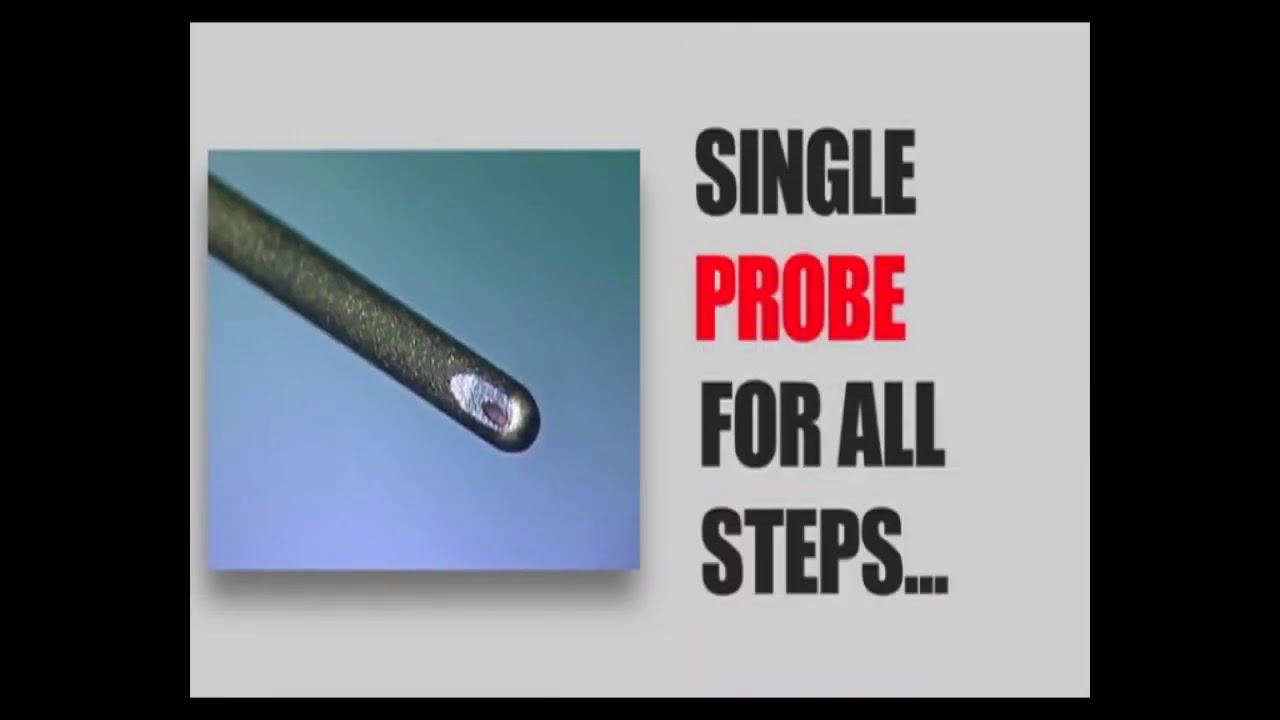 ASCRS 2018 Hypersonic Vitrectomy Final - YouTube