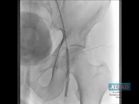 Retrograde Access to Popliteal and CFA - YouTube