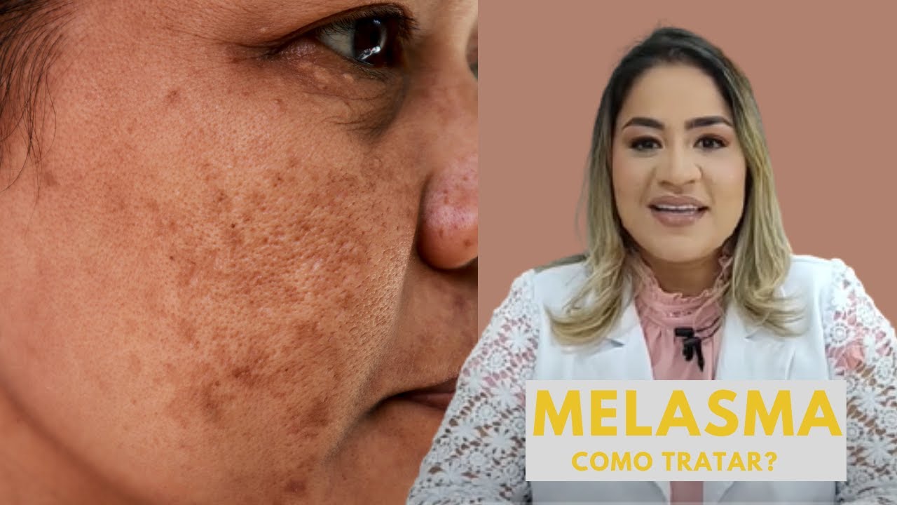 Manchas no Rosto | Melasma | Dra Darciane Rezende - YouTube