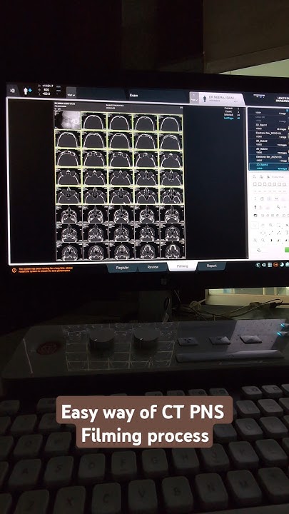 CT PNS filming on United imaging || CT scan || Easy filming process #radiographer #unitedimaging ...