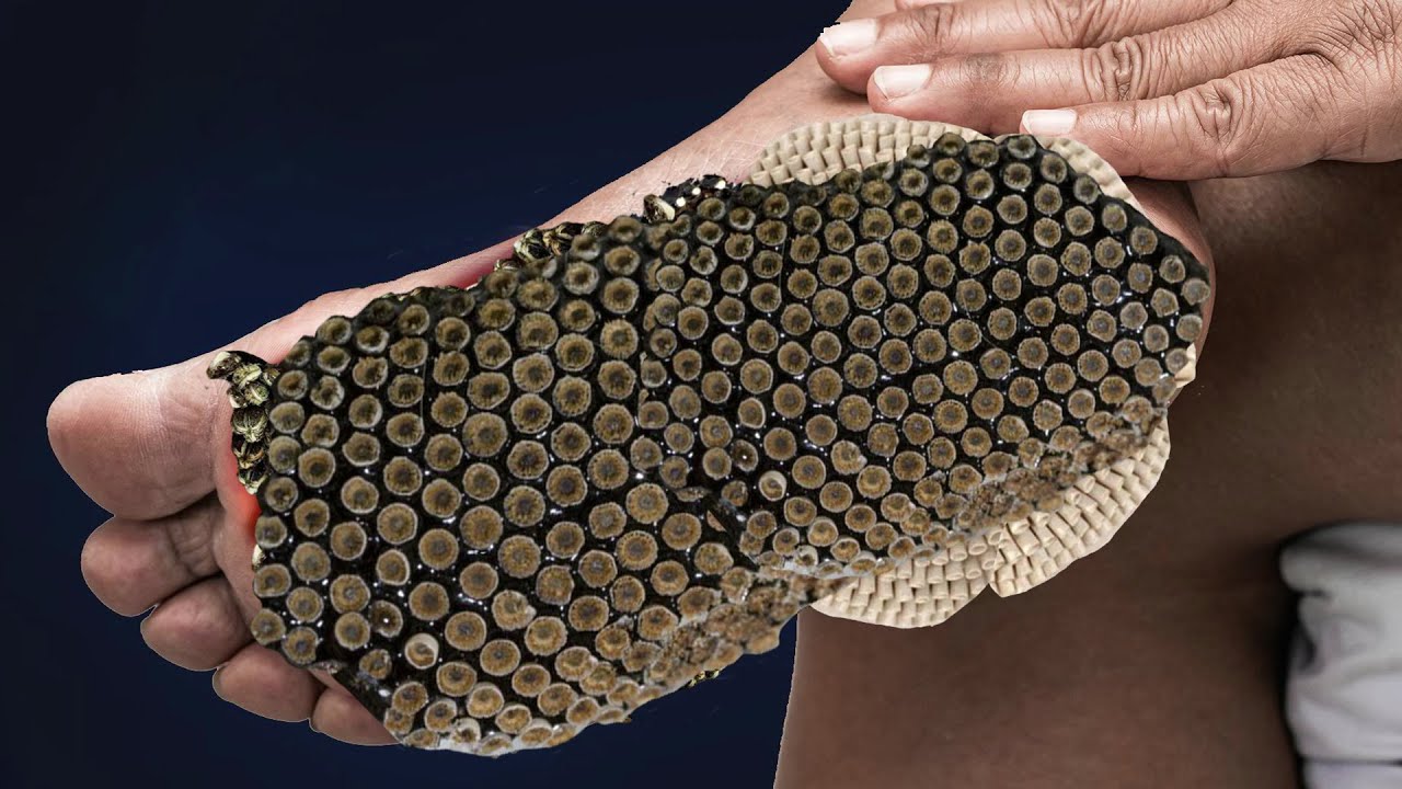 ASMR Remove Maggots & Worm Infected Foot | Deep Cleaning Animation ...